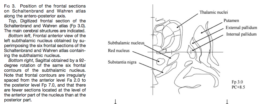 stn_subthalamic_nucleus [Brainstem Wiki]