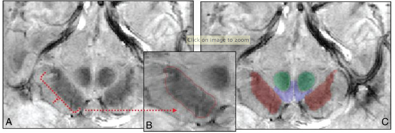 vta [Brainstem Wiki]